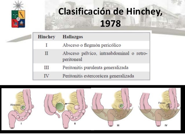 Enfermedad diverticular y complicaciones