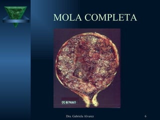 ENFERMEDADES DEL TROFOBLASTO Y DE LA GLANDULA MAMARIA | PPT