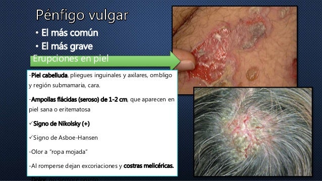 Enfermedades ampollosas - Fisiopatologia