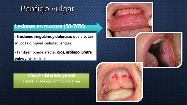 Enfermedades ampollosas - Fisiopatologia