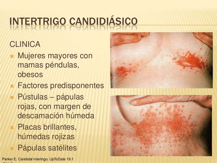 Enfermedades cutáneas producidas por hongos1.pps