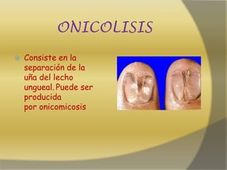 Enfermedades de la uña | PPTX