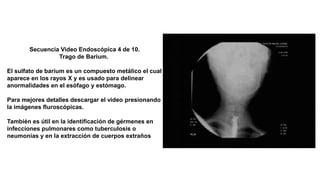 Enfermedades del esofago | PPTX