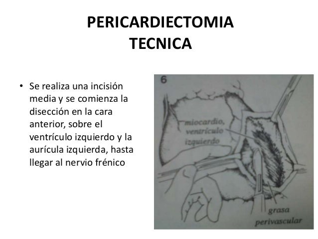 Enfermedades del pericardio