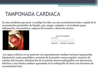 Enfermedades del pericardio | PPTX