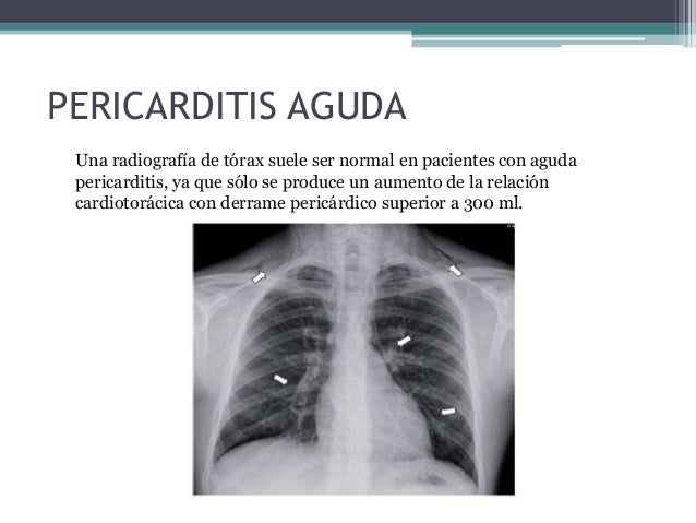 Enfermedades del pericardio