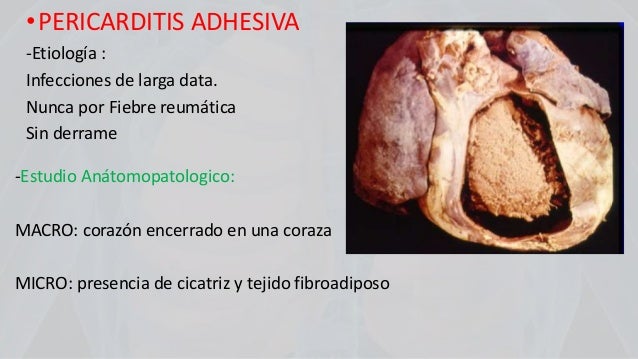 Enfermedades del pericardio