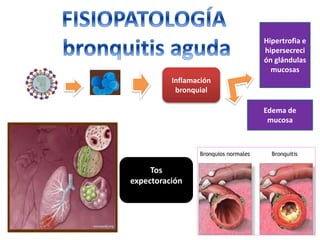 Enfermedades Del Sistema Respiratorio Pptx