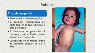 Enfermedades eruptivas de la infancia | PPTX