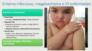 Enfermedades eruptivas de la infancia | PPTX