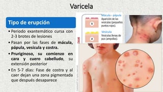 Enfermedades eruptivas de la infancia | PPTX