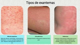 Enfermedades eruptivas de la infancia | PPTX
