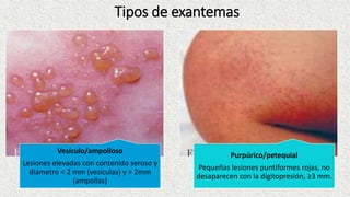 Enfermedades eruptivas de la infancia | PPTX