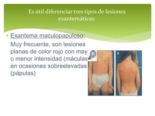 ENFERMEDADES ERUPTIVAS DE LA INFANCIA | PPTX