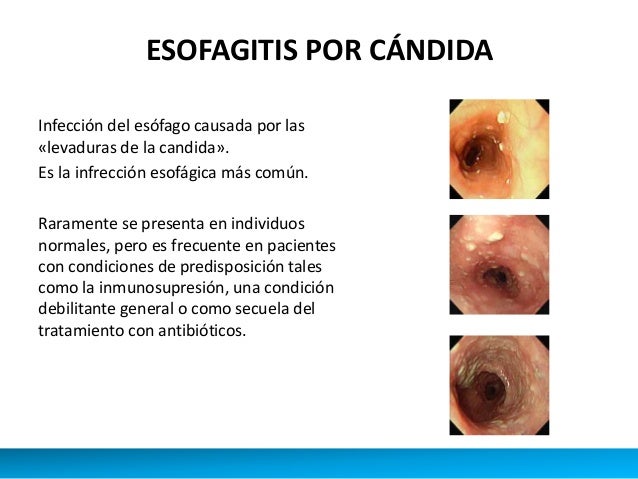 Enfermedades Del Esofago Enfermedades Esofago Ya (1) |authorSTREAM