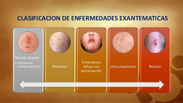 Enfermedades exantematicas en la infancia- ULISES REYES GOMEZ