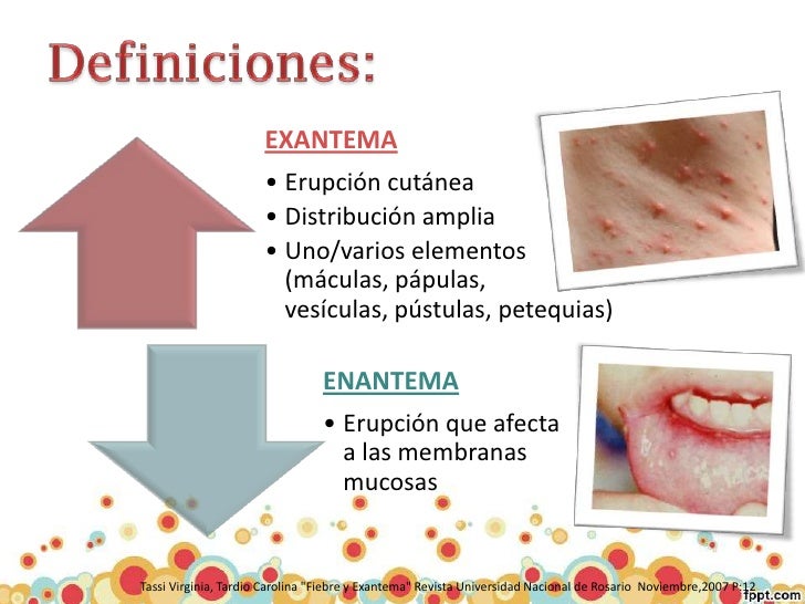 Enfermedades exantemáticas