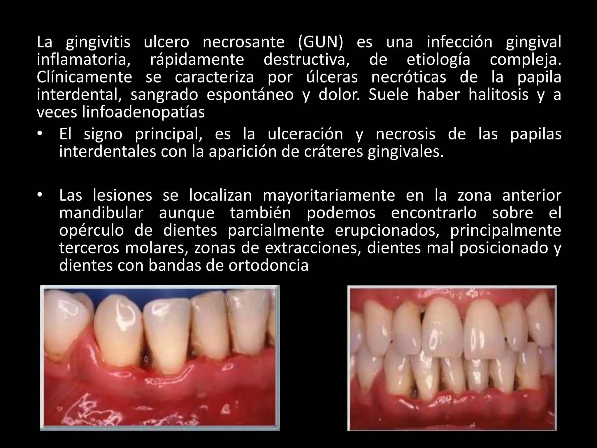enfermedades gingivales inducidas por la placa bacteriana O BIOFILM ...