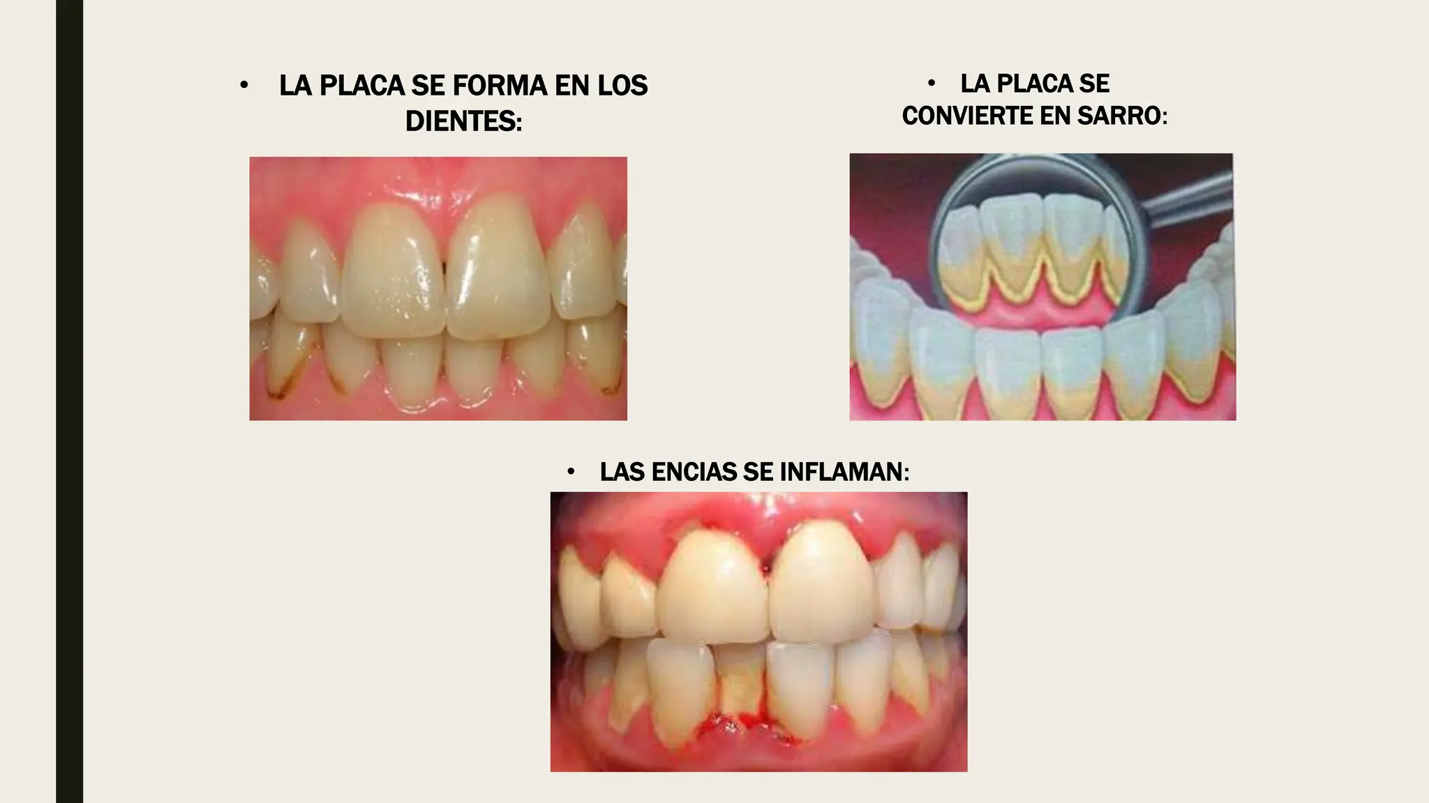 Enfermedades gingivales y periodontales TEJIDO GINGIVAL.pptx