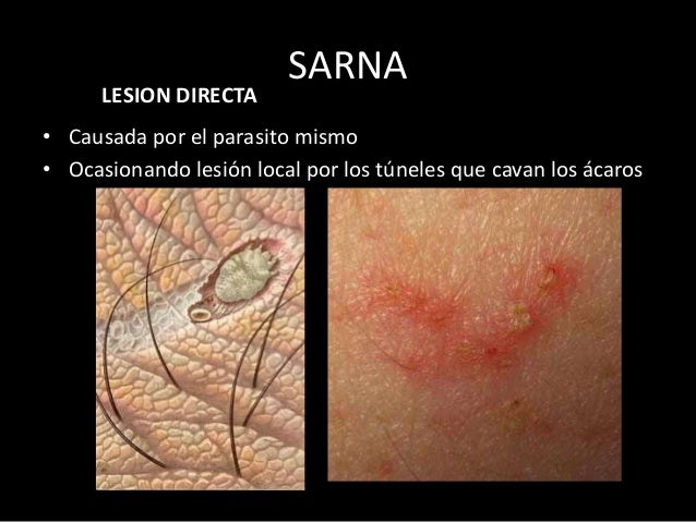 Enfermedades parasitarias de la piel 118