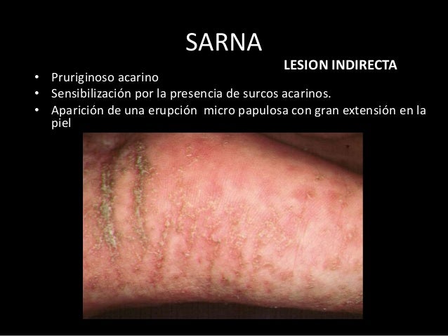 Enfermedades parasitarias de la piel 118