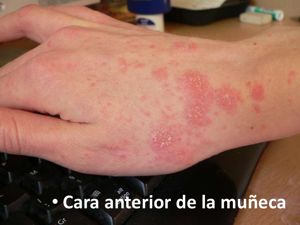 Enfermedades parasitarias de la piel 118