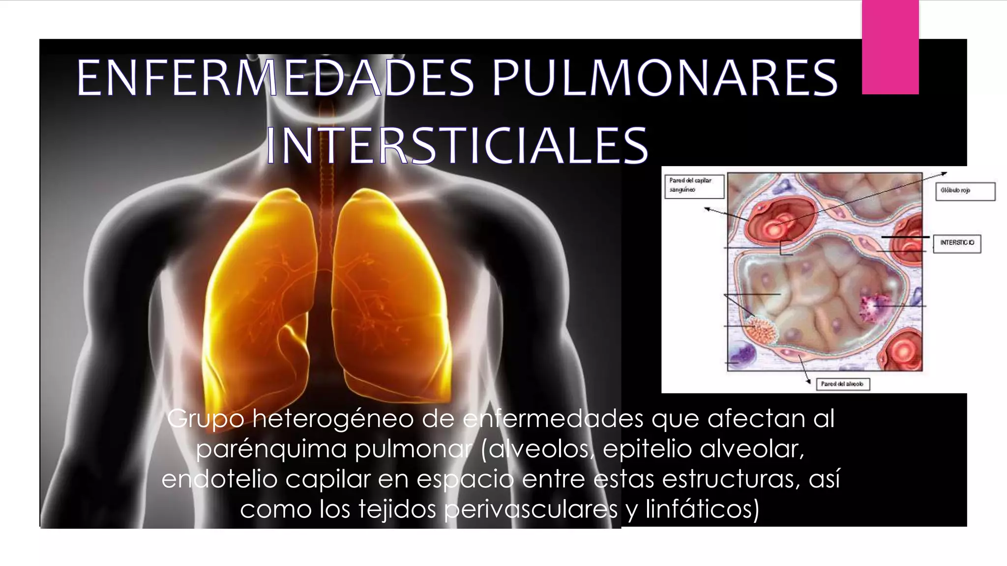 Enfermedades pulmonares intersticiales | PPTX | Lung and Respiratory ...
