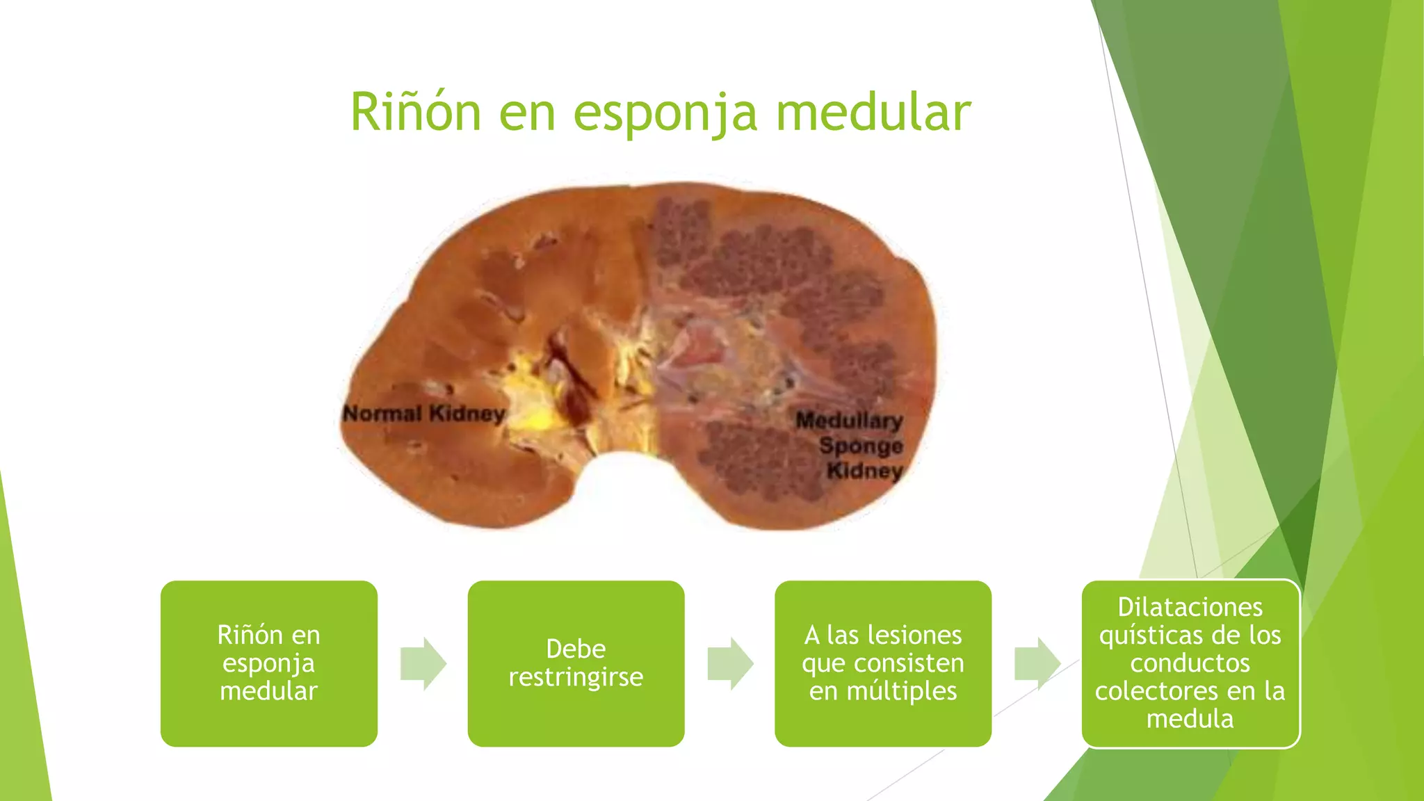 Enfermedades quísticas de la médula renal - Capitulo Renal | PPTX
