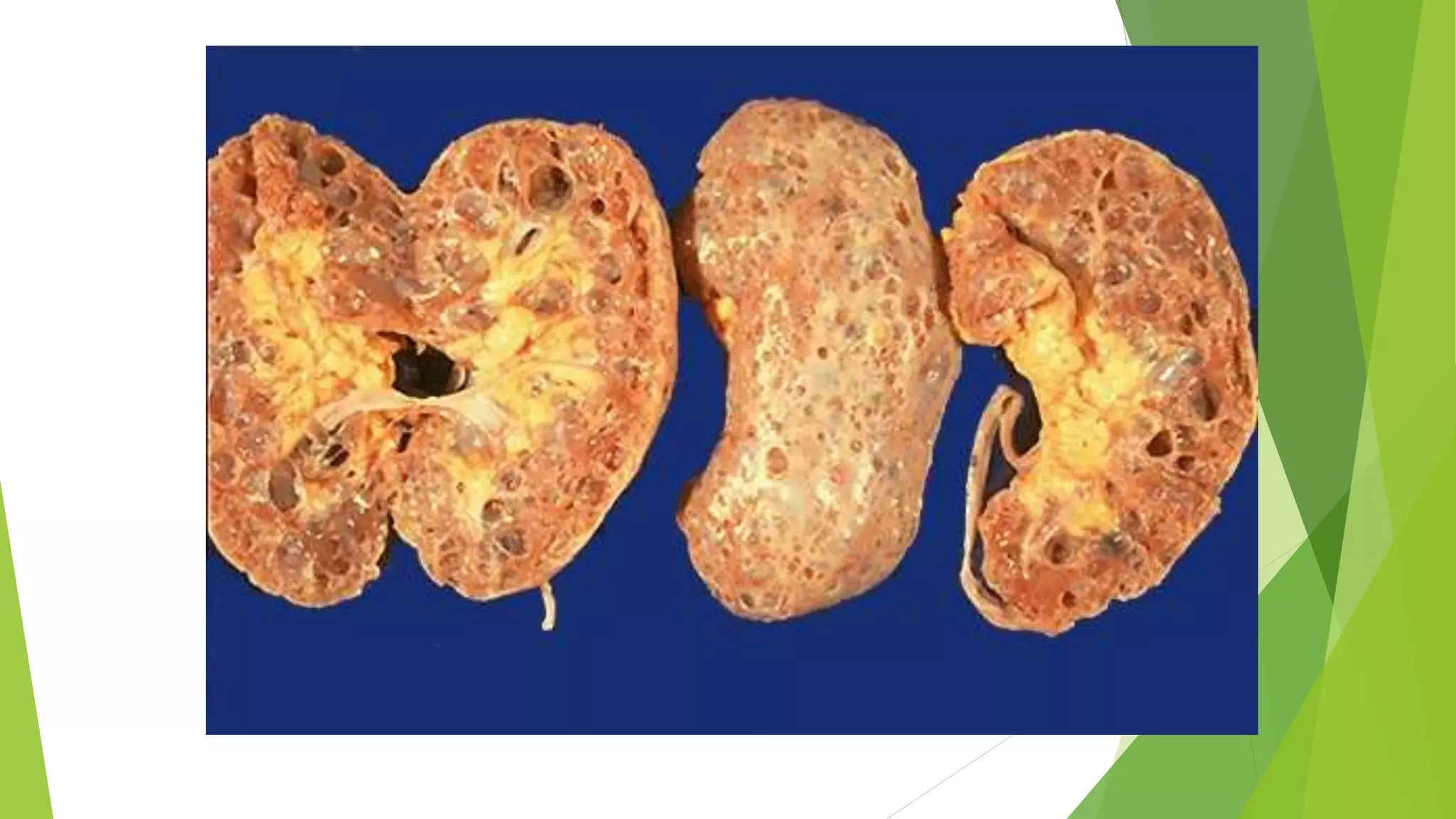 Enfermedades quísticas de la médula renal - Capitulo Renal | PPTX