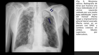 Enfermedades Respiratorias Micoticas | PPTX