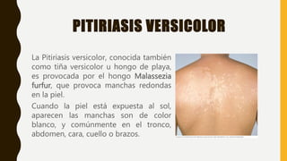 ENFERMEDADES TRANSMITIDAS POR HONGOS.pptx