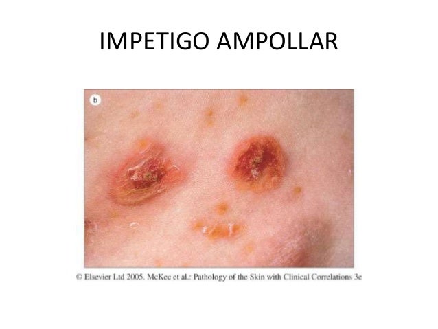 Enfermedades vesiculoampollares Dr. Maldonado (Dermatólogo)