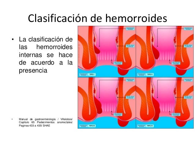 ¿Cuáles Son Los Grados De Hemorroides Internas – TGIDQQ