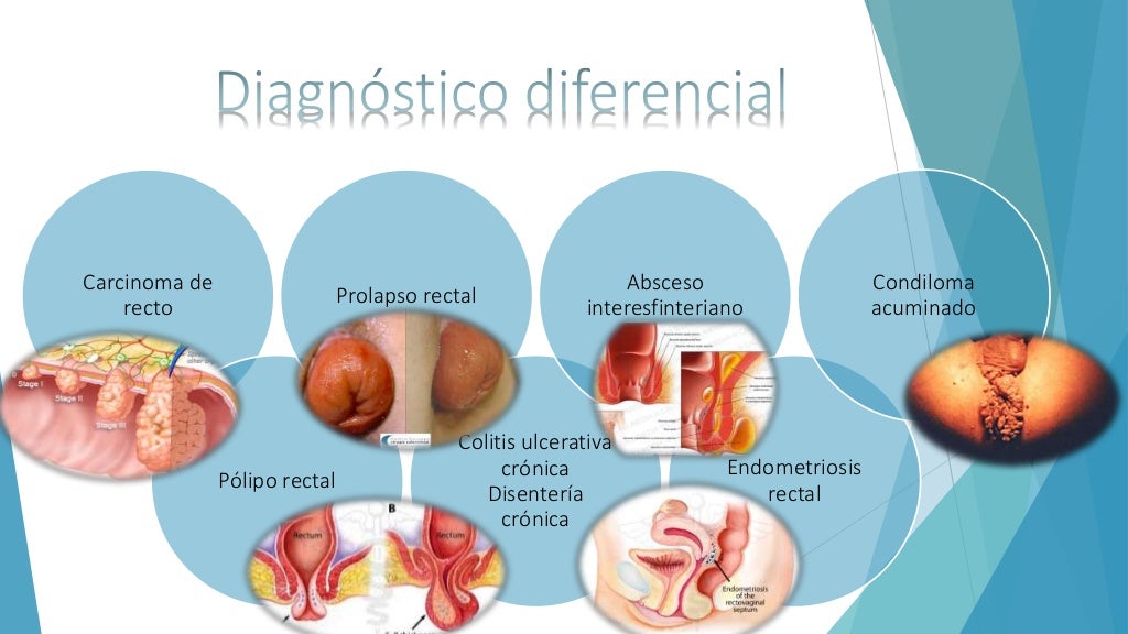 Síndrome Hemorroidal: Causas, Clasificación Y Tratamiento – ZFVLPW