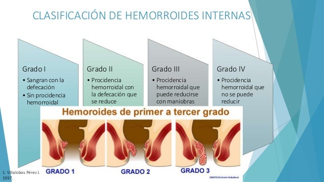 Enfermedad hemorroidal