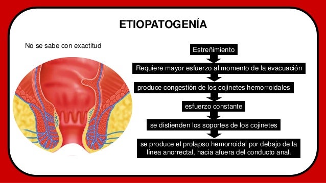 Enfermedad hemorroidal