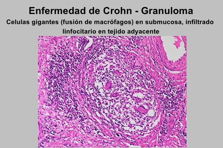 Enfermedad inflamatoria intestinal