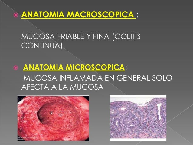Enfermedad inflamatoria intestinal