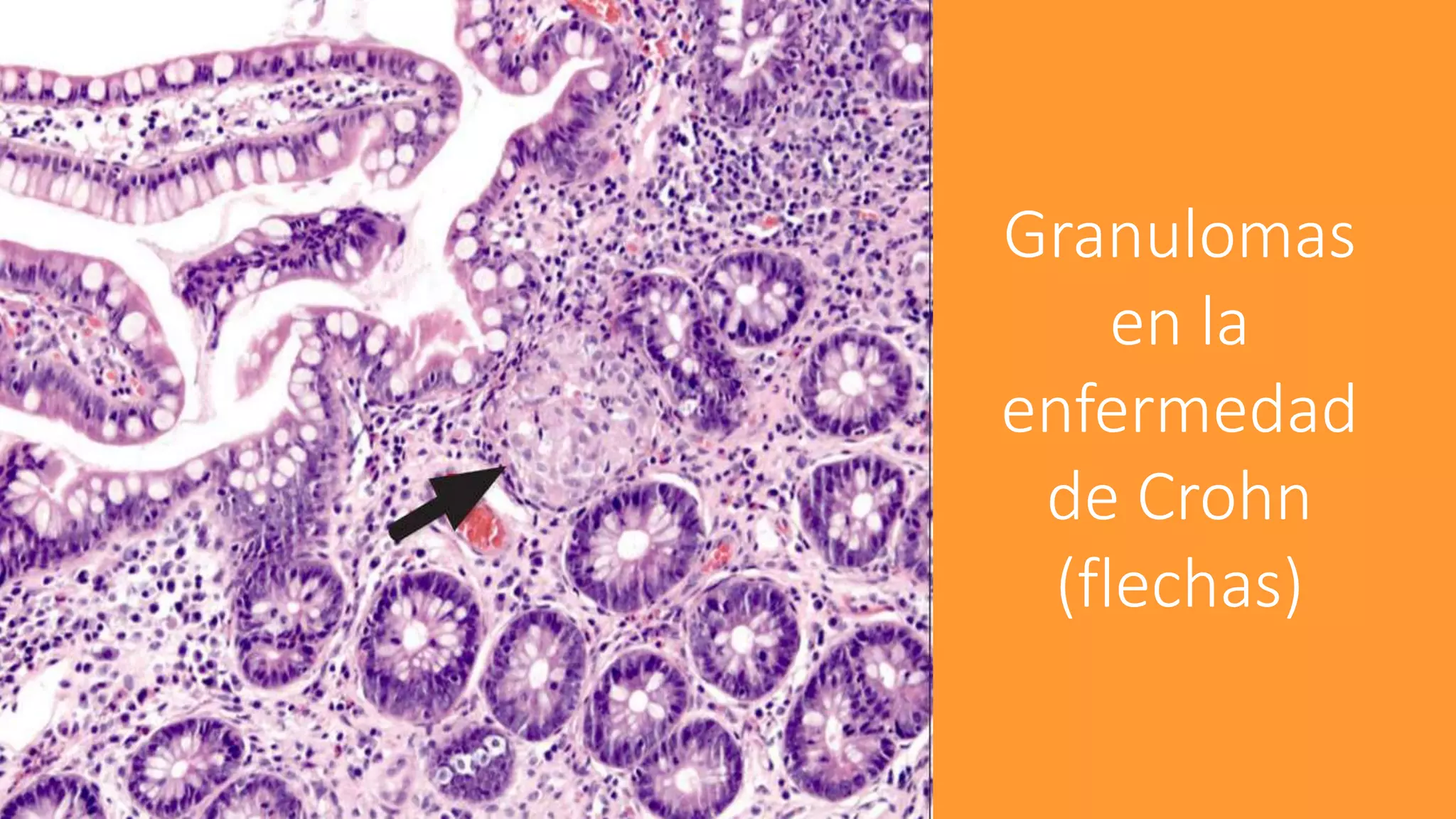 Enfermedad Inflamatoria Intestinal: CUCI y Crohn | PPTX