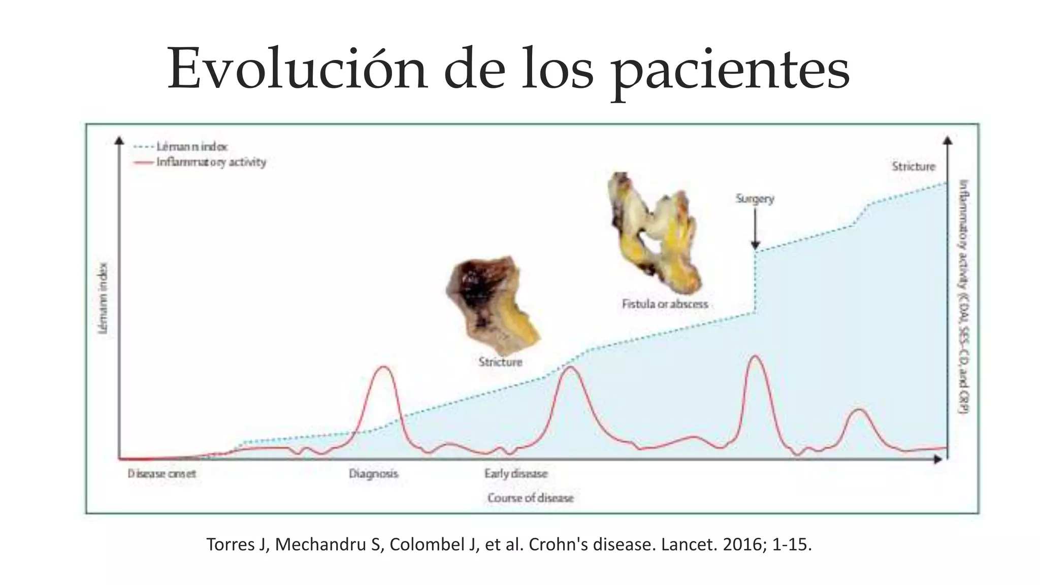 Enfermedad Inflamatoria Intestinal: CUCI y Crohn | PPTX