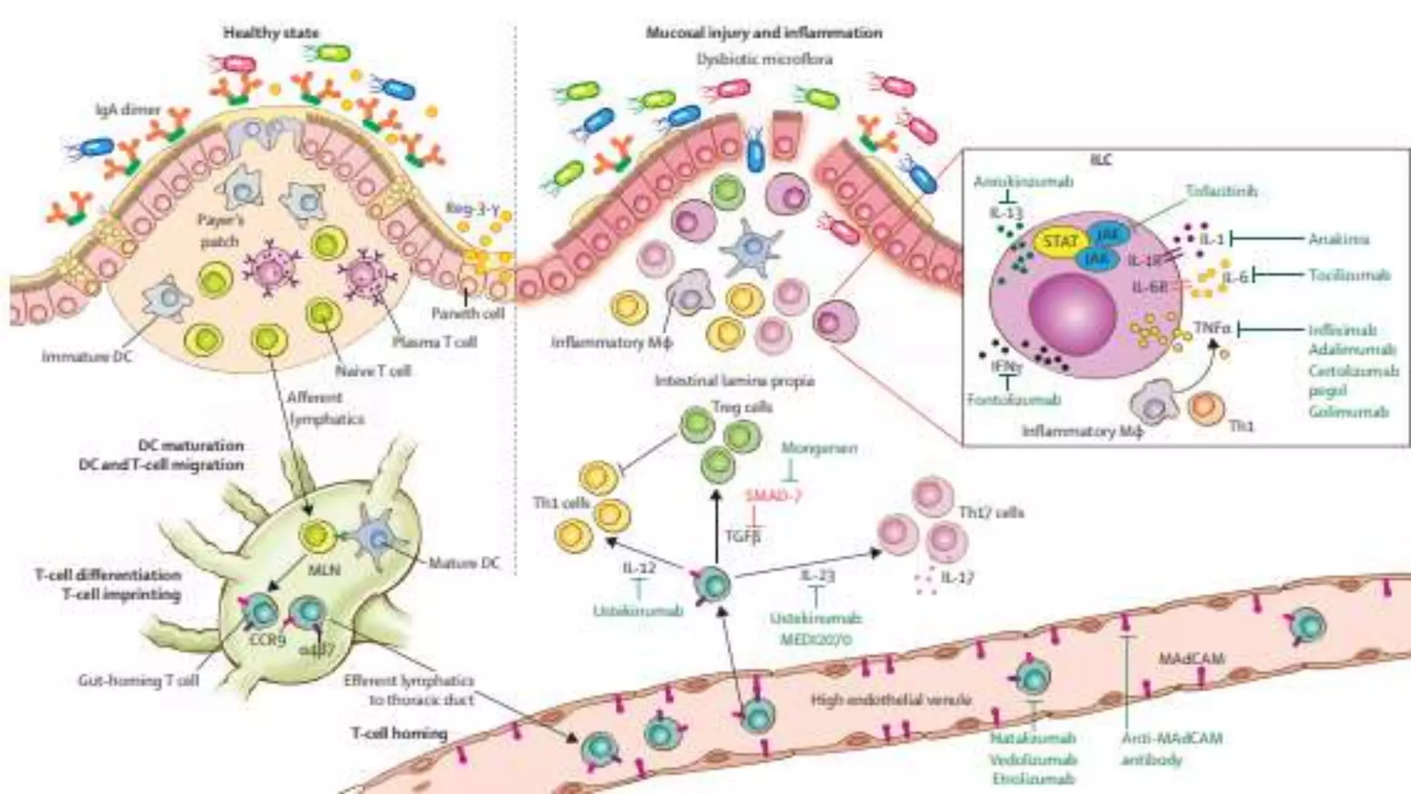 Enfermedad Inflamatoria Intestinal: CUCI y Crohn | PPTX