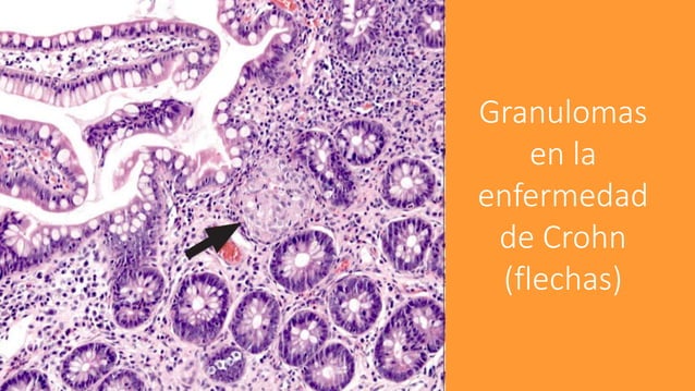 Enfermedad Inflamatoria Intestinal: CUCI y Crohn | PPTX