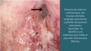 Enfermedad Inflamatoria Intestinal: CUCI y Crohn | PPTX