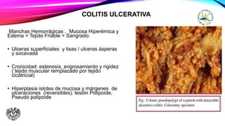 ENFERMEDAD INFLAMATORIA INTESTINAL Y MEGACOLON.pptx