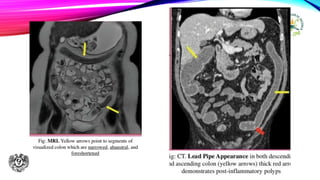 ENFERMEDAD INFLAMATORIA INTESTINAL Y MEGACOLON.pptx