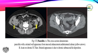 ENFERMEDAD INFLAMATORIA INTESTINAL Y MEGACOLON.pptx