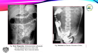 ENFERMEDAD INFLAMATORIA INTESTINAL Y MEGACOLON.pptx