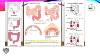 ENFERMEDAD INFLAMATORIA INTESTINAL Y MEGACOLON.pptx