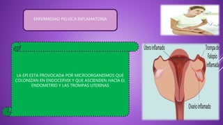 Enfermedad inflamatoria pelvica | PPTX
