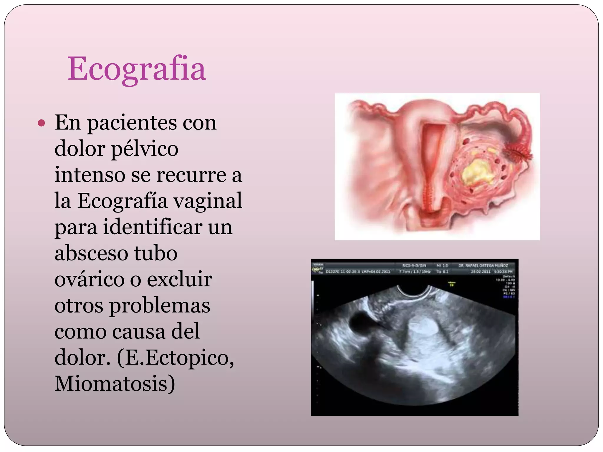 Enfermedad inflamatoria pélvica | PPT